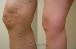 Treatment for Varicose Veins | Jozef Tryzno, MD